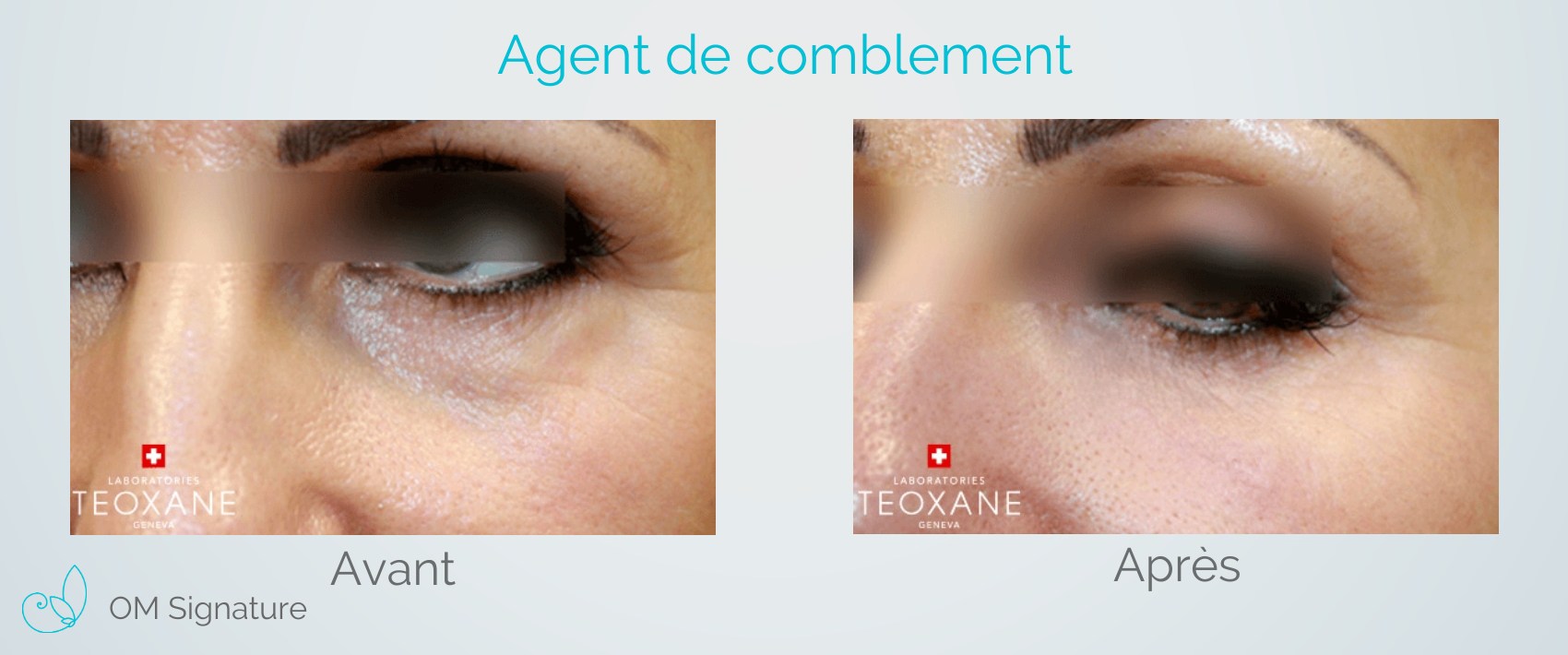 Cernes creux sous les yeux | Injection acide hyaluronique Cernes creux sous les yeux | Injection acide hyaluronique